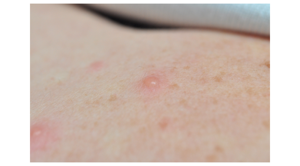 Learn How Vaccines Have Improved Lives Throughout History