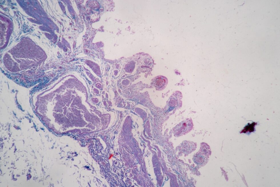 How Analyzing Histology Samples Leads to Diagnosis and Disease ...